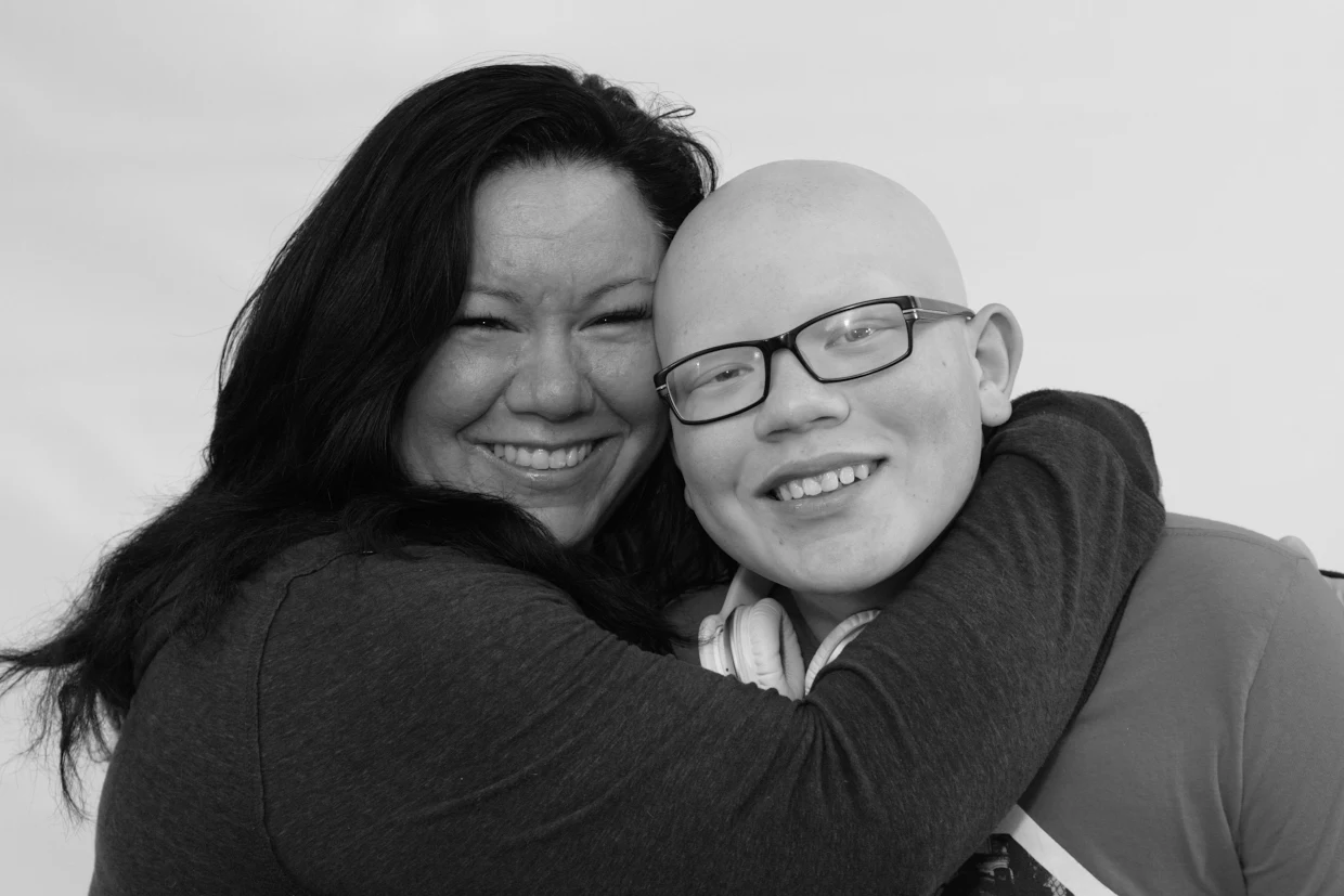 Alopecia Areata - National Alopecia Areata Foundation | NAAF