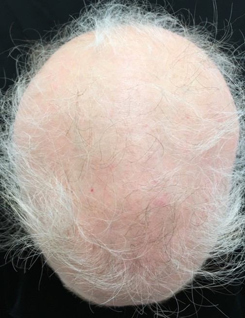 Alopecia Areata Types - National Alopecia Areata Foundation | NAAF