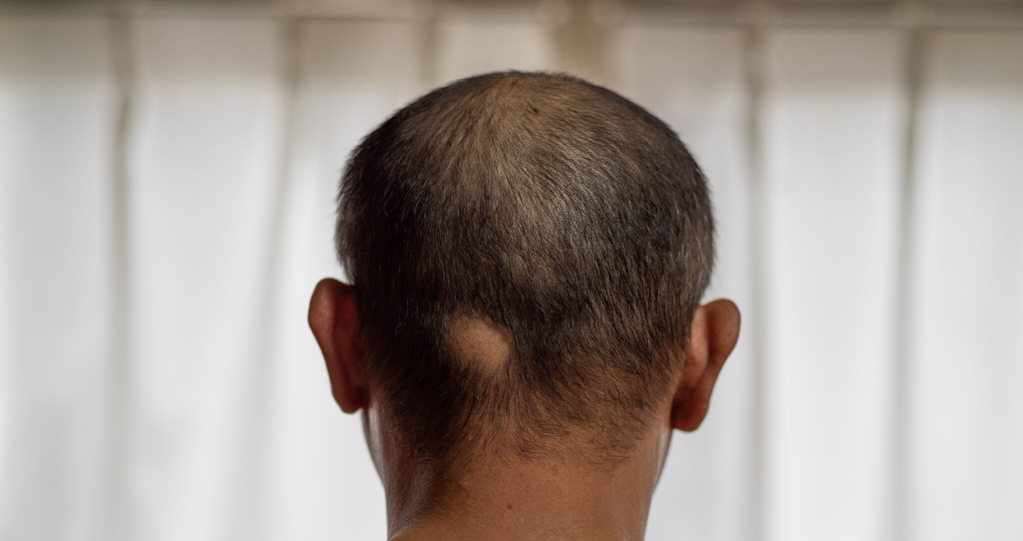 Alopecia Areata - National Alopecia Areata Foundation | NAAF