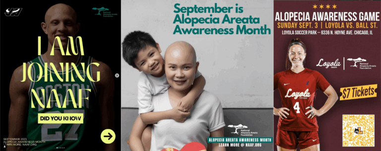 Alopecia Areata Awareness Month - National Alopecia Areata Foundation ...